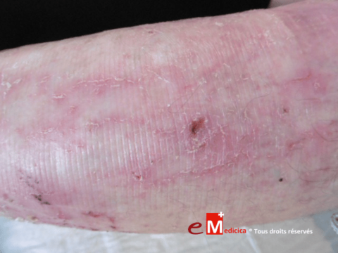 Eczema craquelé