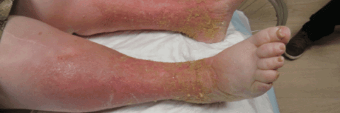 Dermite de stase : définition, diagnostic et prise en charge